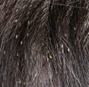 pediculose | PortalPed