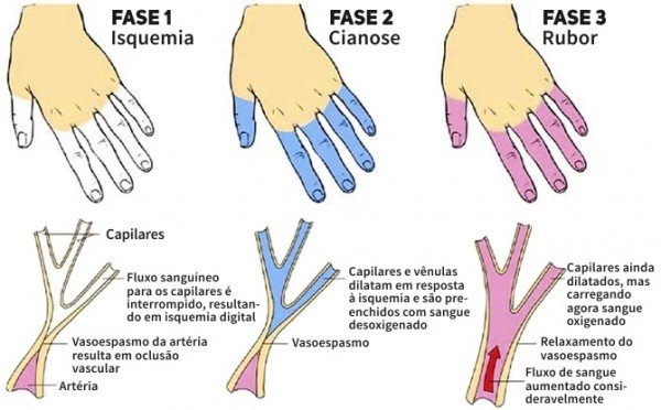 Fenômeno de Raynaud em crianças: uma revisão crítica | PortalPed
