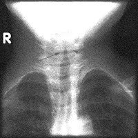 Crupe Viral: do Diagnóstico ao Tratamento | PortalPed