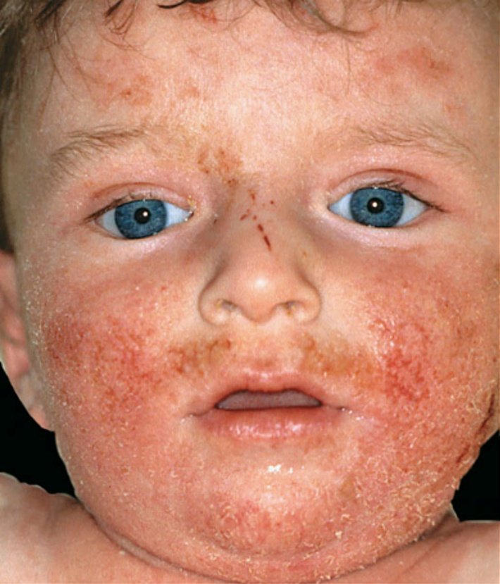 O Que é Dermatite Atópica Em Bebê - Livros