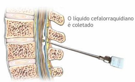 Série Procedimentos em Pediatria: a Punção Lombar | PortalPed