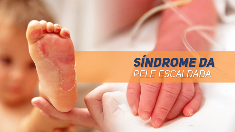 doença de Ritter | PortalPed